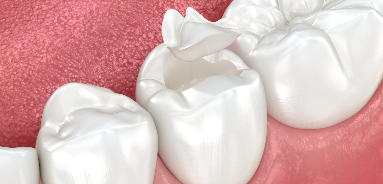 Five Common Dental Crown Problems Solved | How They Work